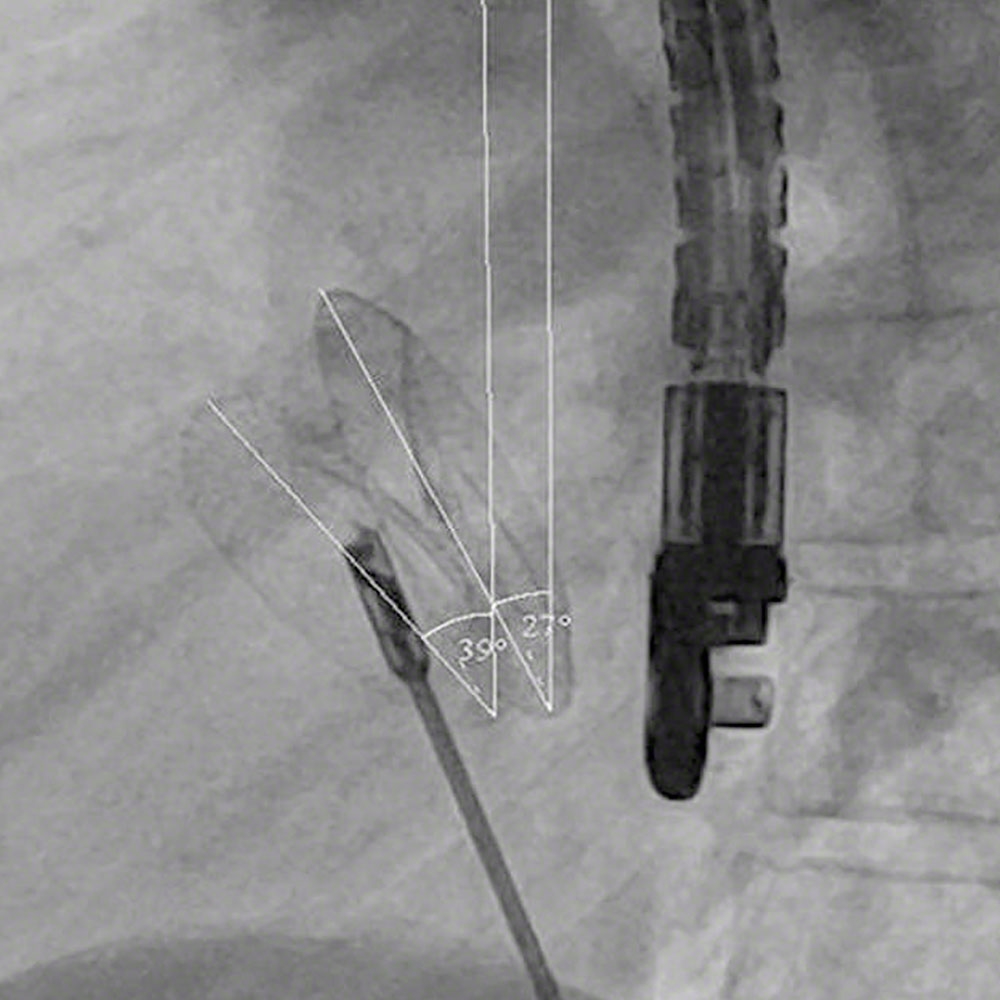 Occlutech® ASD Occluder